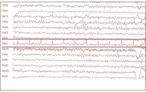 Figure 8 From Classification Of Artefacts In Eeg Signal Recordings And Eog Artefact Removal