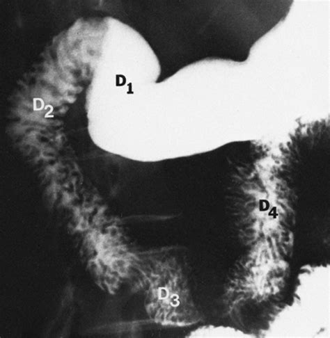 The Stomach And Duodenum Radiology Key