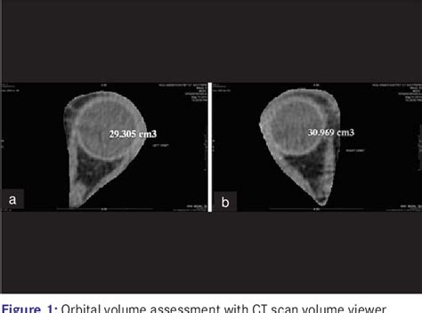 Figure 1 From Mandibular Symphysis Graft Versus Iliac Cortical Graft In Reconstructing Floor In