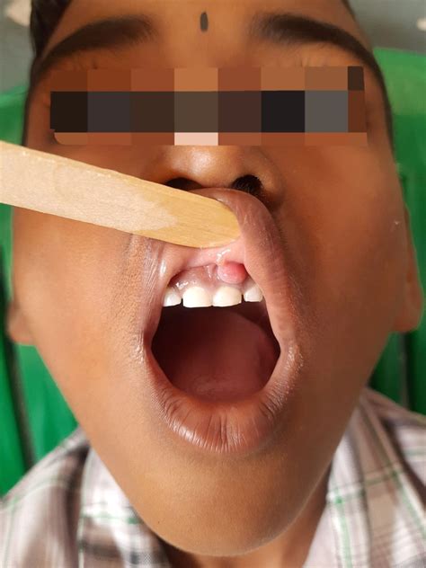 Dr Kritika Mishra On Linkedin Gingival Abscess The Intrusion Of Bacteria In The Gum Leads To A…