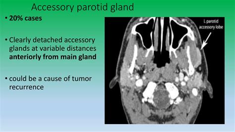 Parotid Gland Anatomy Ct