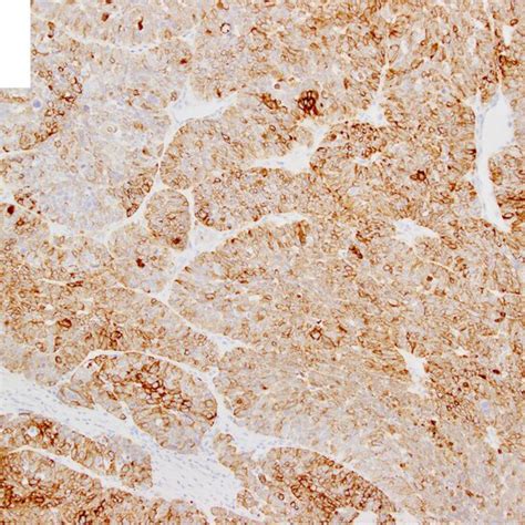 A Epithelial Cell Proliferation With Partial Glandular Duct Formation Download Scientific