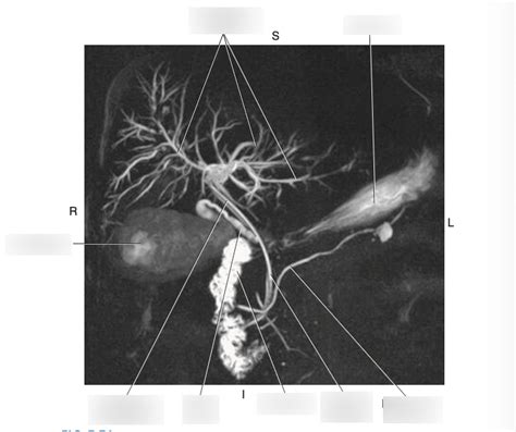 Fig 7 71 Mr Cholangiopancreatogram Mrcp Of Biliary System Diagram