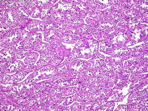 Alveolar Soft Part Sarcoma
