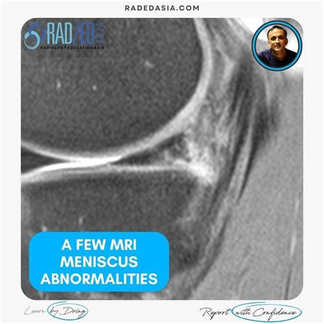 A Few Mri Meniscus Abnormalities Meniscus Tear Intra Meniscal Cyst And Variants That Look Like