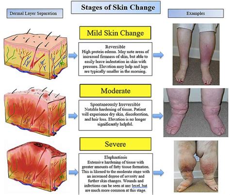 Mild Lymphedema