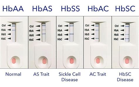 Sickle Cell Anemia Test