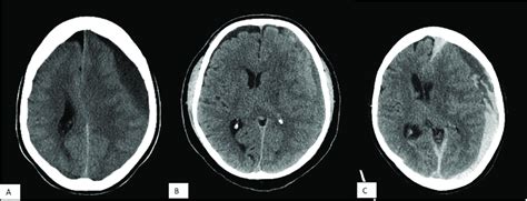 Acute Vs Chronic Subdural Hematoma