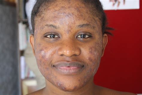 How To Burst Pimples Like A Professional