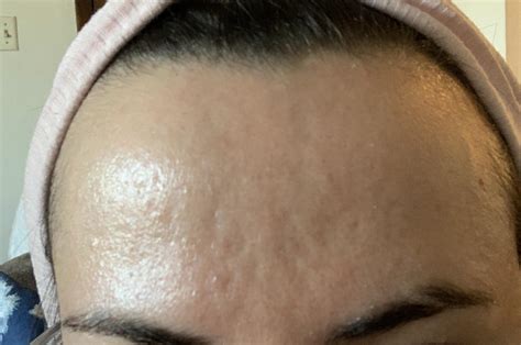 [routine Help] Forehead Texture Nothing Seems To Help Routine In Comments R Skincareaddiction