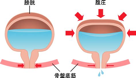 腹圧性尿失禁 医療法人社団 典俊会｜帯広泌尿器科／とかち泌尿器科
