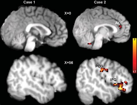 Activation Maps Depicting Areas Of Statistically Increased Activation Download Scientific