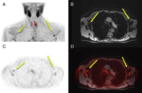Bilateral Lymphadenopathy After Covid Vaccine In 18f Choline