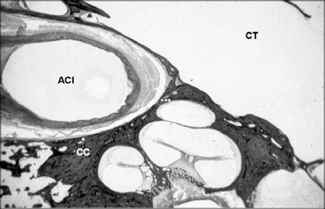 Carotid Canal Ct