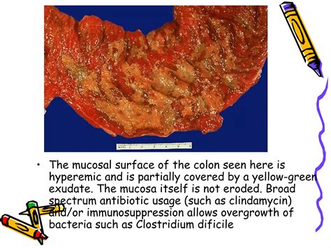 11 Pseudomembranous Colitis Images Ppt