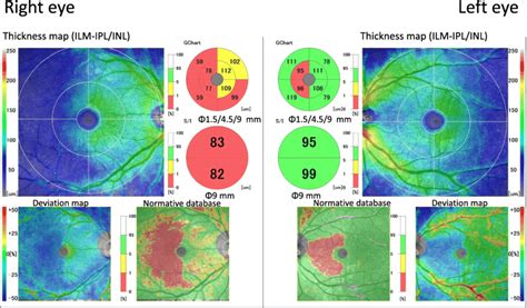 Macular Cube Scan Images With Spectral Domain Optical Coherence