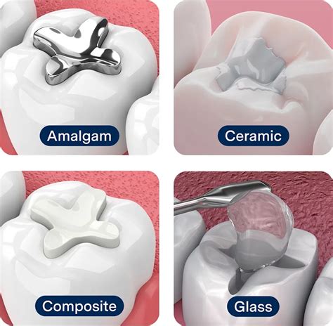 How Long Does It Take To Fill A Cavity Aspen Dental