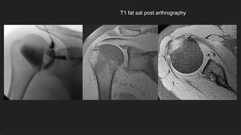 Shoulder Mr Arthrogram 31m With Pain 6 Weeks After Fall Ocad