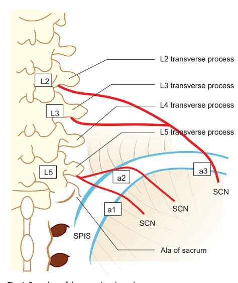 Figure 1 From Superior Cluneal Nerve Entrapment—possible Pain Generator