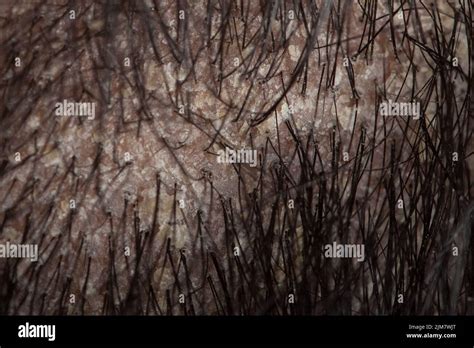 Dry Flaky Scalp Dandruff Problem Psoriasis Asian Man Have Flaking On Scalp Macro View Stock
