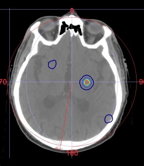 Efficiency And Benefits Of Linac Based Sbrtsrs Program