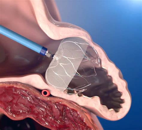 Nvaf Patient Selection For Watchman For Physicians