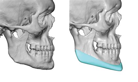 Custom Jaw Implants Chin Implants Eppley Custom Facial Implants