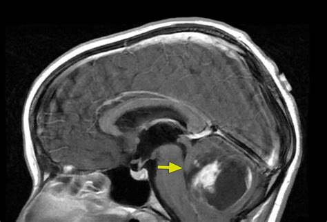 Pediatric Brain Tumors Imaging Matters