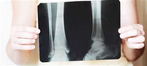 DEXA Bone Density GBMC HealthCare In Baltimore MD