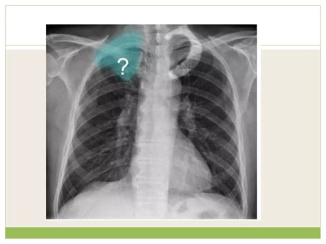 BASIC CHEST X RAY INTERPRETATION PPTX