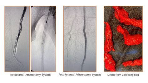 Rotarex™ Rotational Excisional Atherectomy System
