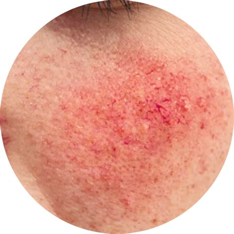 Rosacea Treatment Dermondemand