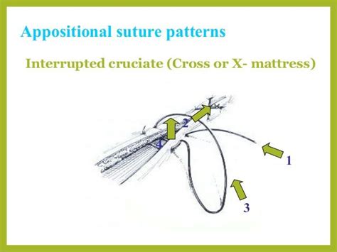 Basic Suture Patterns Sutures Pattern Basic