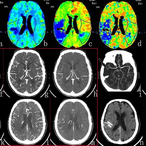 A Female Patient 83 Years Old With An Nihss Score Of 12 Cbf A And