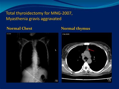 Ppt Considerations Regarding The Role Of 99m Tc Tetrofosmin Thymic