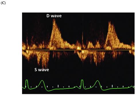 Pulmonary Venous Flow Patterns As Imaged On Transesophageal