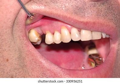 18 Wedge Shaped Defect Images Stock Photos Vectors Shutterstock