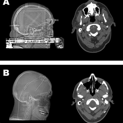 We Show Here Sagittal And Transverse Sections Taken From Ct Scans Download Scientific Diagram