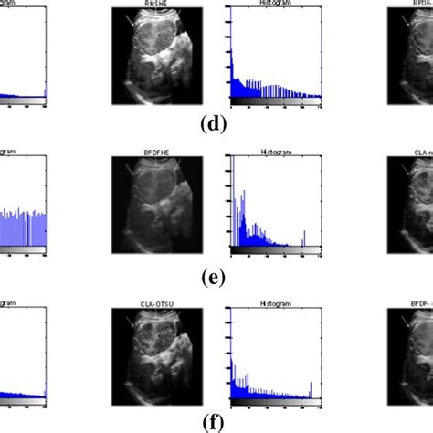 The Simulation Results Of The Proposed Algorithm On Ultrasound Liver Download Scientific