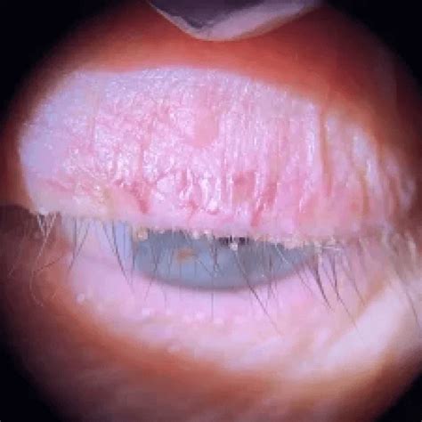 Demodex Blepharitis Xdemvy® Lotilaner Ophthalmic Solution 0 25