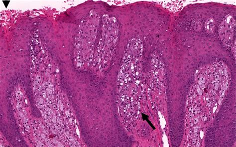 Xanthoma Dermnet New Zealand