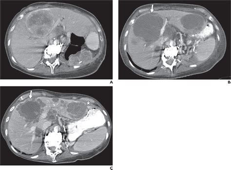 Figure 1 From Recist 1 1 Compared With Recist 1 0 In Patients With Advanced Renal Cell Carcinoma