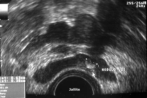 Nodulo Solido Vesicula Seminal