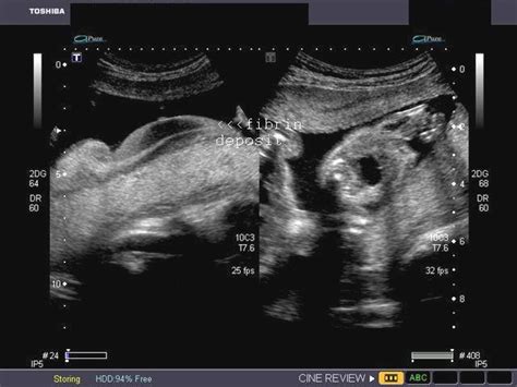 On Radiology Subchorionic Cyst Lesion Of The Placenta