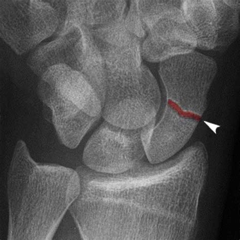 Scaphoid Fractures Diagnosis And Treatment Dr Arthur Turow