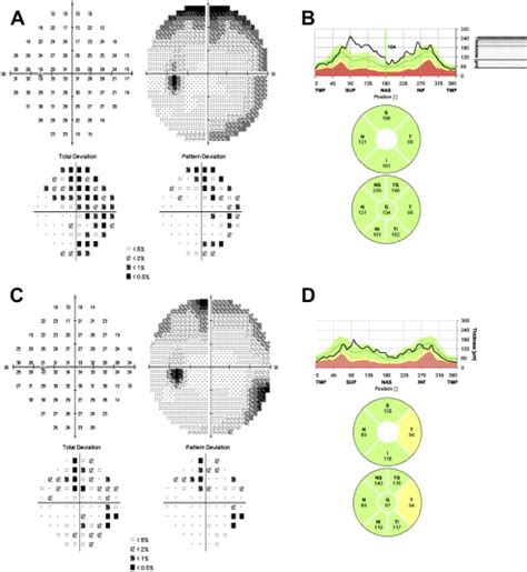 Visual Issues In Multiple Sclerosis Musculoskeletal Key