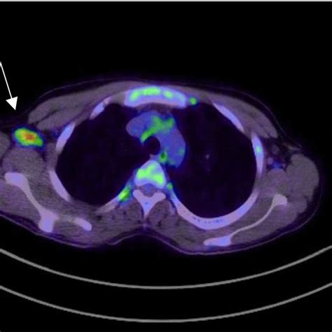 A Hypermetabolic Left Cervical Lymph Node 1 3 Cm In Diameter Suv Of Download Scientific