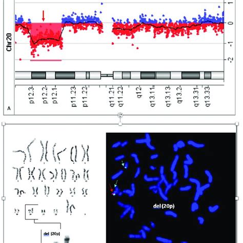 Cytogenetic And Molecular Cytogenetic Results Of Case 1 And Case 7 A Download Scientific