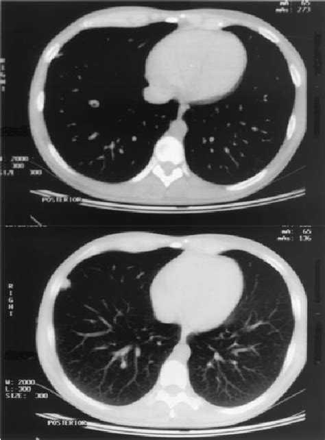 Chest Computed Tomography Showing A Pulmonary Nodule In The Right Lower Download Scientific