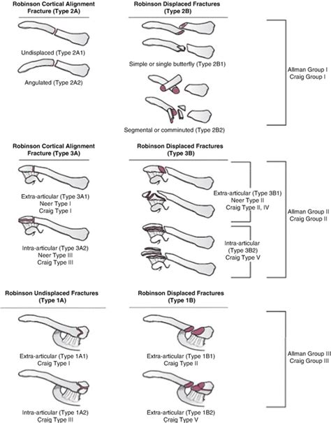 Midshaft Clavicle Injuries Operative Management Musculoskeletal Key